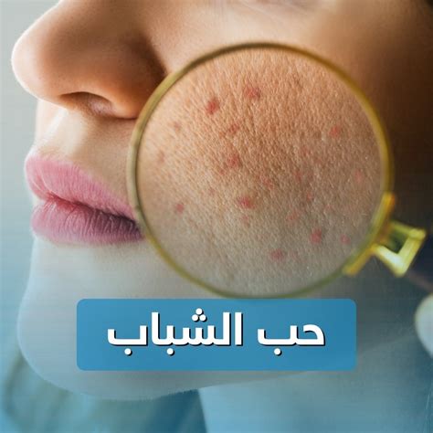 حب الشباب Barbiephar