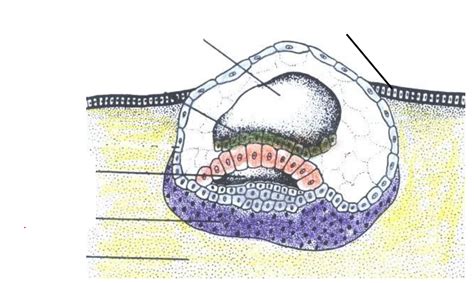 Diagram Of Interstitial Implantation Quizlet
