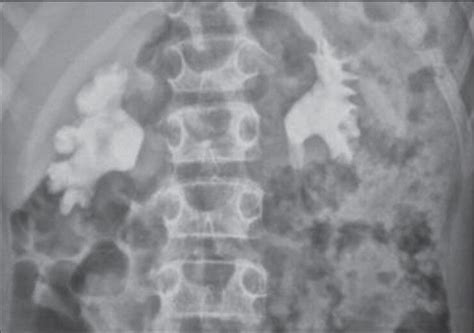 Ivu Showing Rt Dilated Pelvic Calyceal System With Small Renal Pelvis