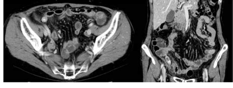 Figure 1 From Primary Neuroendocrine Carcinoma Of The Appendix A Case