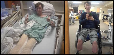 Man Shares Picture 1 Month After Amputation Due To Severe Frostbite