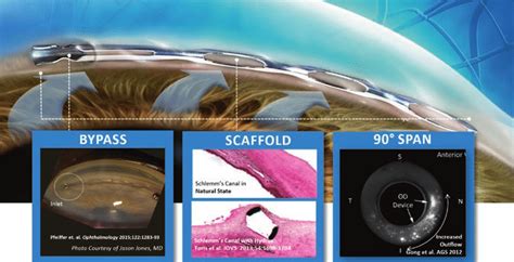 3 The Hydrus ® Microstent Delivery System Copyright Ivantis Inc