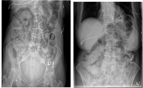 Defecation Syncope A Poorly Described Phenomenon That Should Not Be