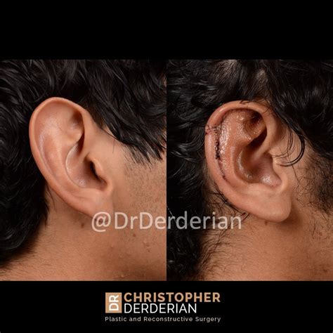 Reduction Otoplasty — Dr Derderian — Plastic And Reconstructive Surgery