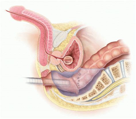 Right Hemicolectomy Open Technique Basicmedical Key