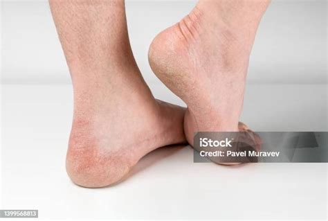 회색 배경에 건조하고 금이 간 발바닥 마른 발 뒤꿈치가있는 남자 발 금이 간 피부 나쁜 피부가 덮인 발 뒤꿈치에 균열을 닫습니다