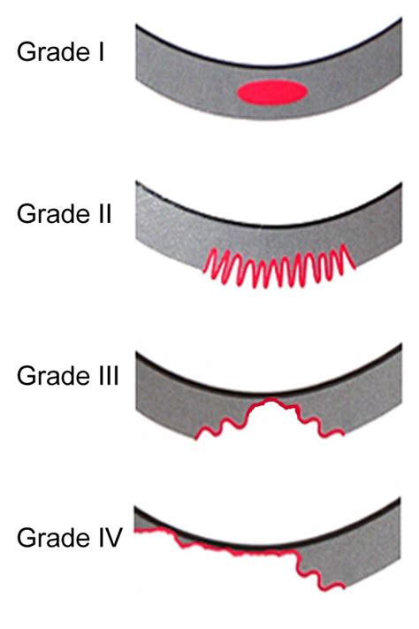 Schematic Drawings To Illustrate The Grading Of Cartilage Diseases As