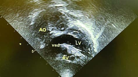 Echocardiography Showing A Large Vsd With Over Riding Aorta Trunk
