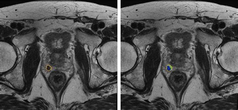 Mri Detection Of Prostate Cancer Quibim