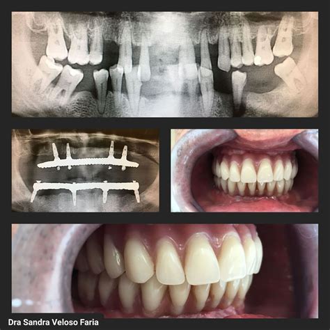 Protese Fixa Sobre 4 Implantes Hibrida