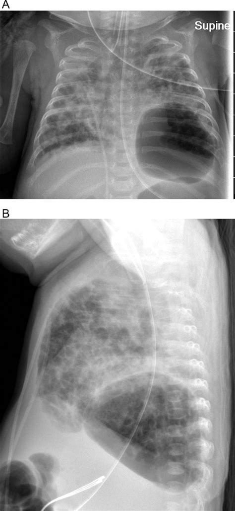 Figure 1 From Successful Ultrasound Guided Percutaneous Drainage Of