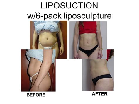 Undergo Liposuction In Delhi For Best Results Liposuction In Delhi