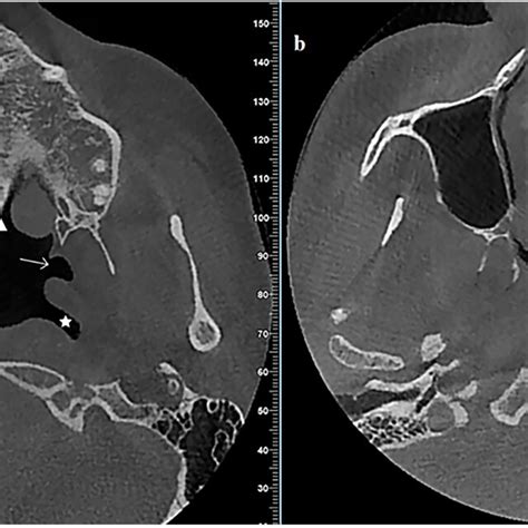 A Stars Rosenmuller Fossa White Arrows Eustachian Tube Orifice Download Scientific