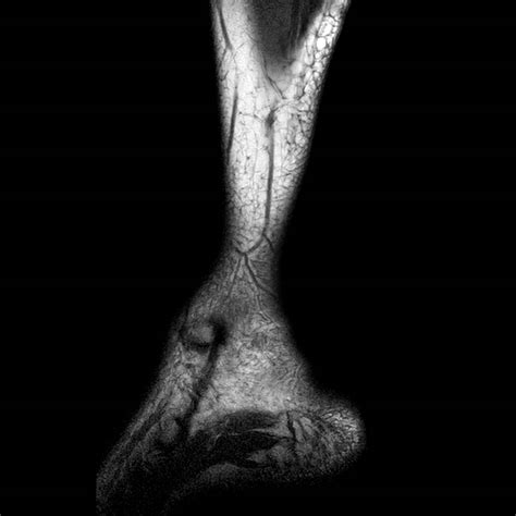 Fileachilles Tendon Rupture Complete Radiopaedia 61601 69580