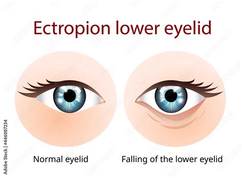 Photo And Art Print Ectropion Lower Eyelid Ectropion Is A Condition In