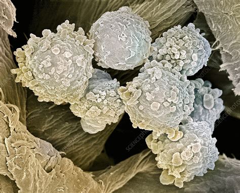 Leukaemia Blood Cells SEM Stock Image M132 0870 Science Photo