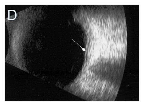 Comparison Of Retinal Sdoct A C E With Ultrasonography B D F Download Scientific