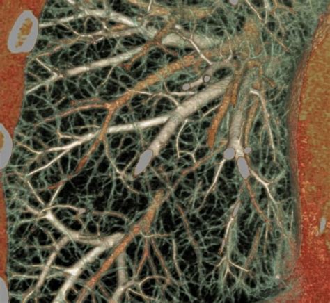 Photon Counting L Philips Healthcare Photon Counting L Philips Healthcare