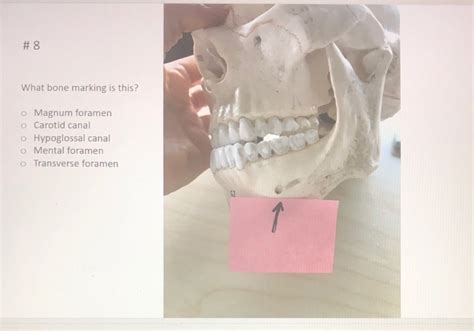 Solved Re 13 What Bone Marking Is This Mental Foramen