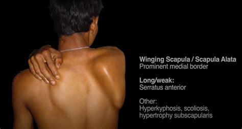 Scapular Alignment Scapular Dyskinesis Assessment