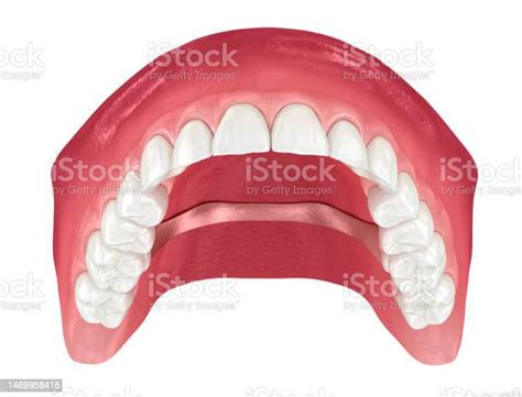 잇몸을 가진 상악 보철물 모두 임플란트에 의해 지원되는 6 개의 시스템에 있습니다 치과용 3d 일러스트레이션 Edentulous에 대한 스톡 사진 및 기타 이미지 Istock