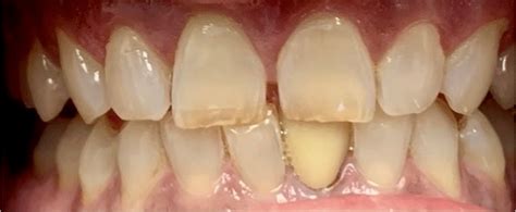 Smile Gallery Winter Dental Dentist Arvada Co