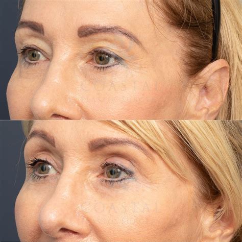 Blepharoplasty Gallery Coastal Plastic Surgery Sydney