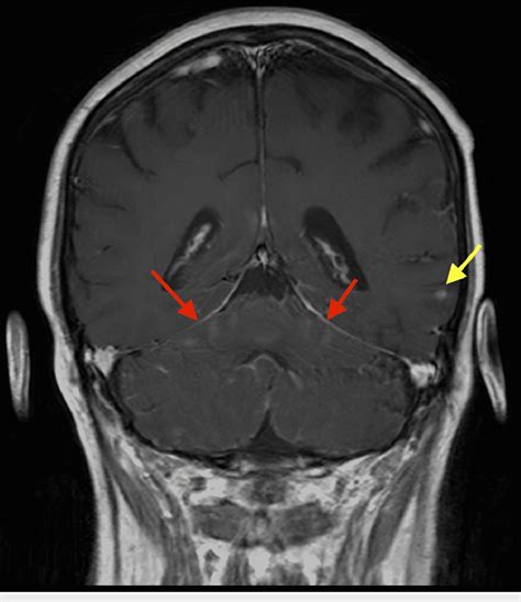 Brain MRI Coronal View During T1 Post Contrast Showing Interval