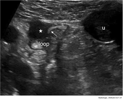 Bowel Ultrasound Examination Techniques And Normal And Pathologic Patterns Radiología