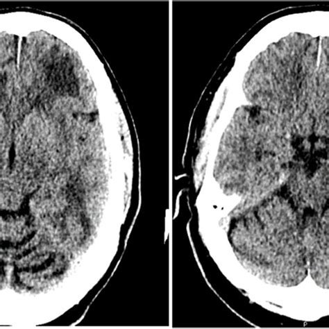 Ct Without Contrast Initial Scan On Presentation This Head Ct Download Scientific Diagram