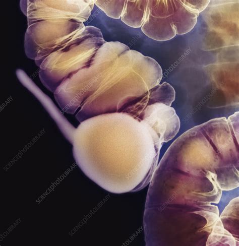 X Ray Of Appendix Stock Image P5600086 Science Photo Library