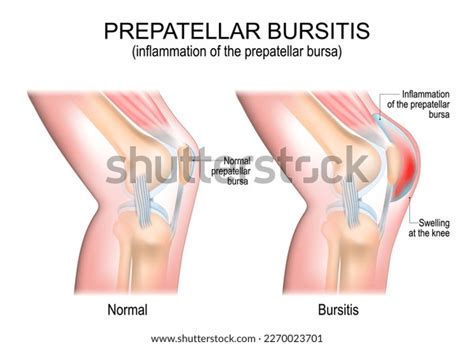 Prepatellar Bursitis Inflammation Prepatellar Bursa Comparison Stock Vector Royalty Free
