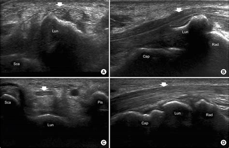 Flexor Tendons Wrist Ultrasound