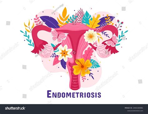 Endometriosis Vector Illustration Condition Endometrium Grows Stock