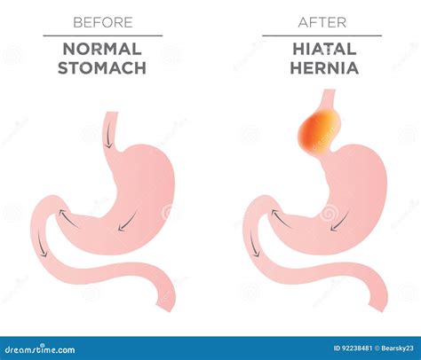 Purple Herniated Belly Button At Jake Burdekin Blog