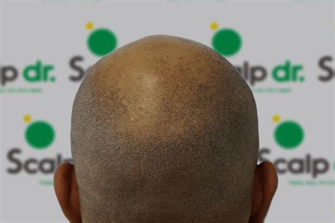 SMP For Men SMP Image Gallery Scalp Dr