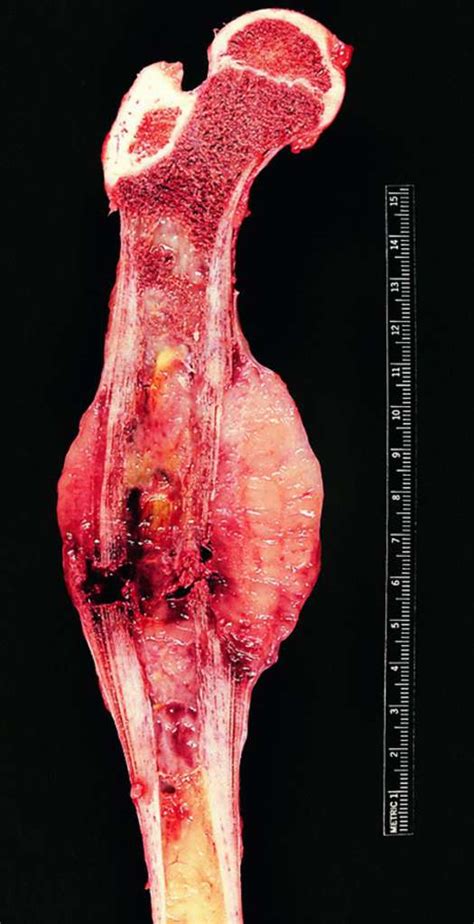 Ewing Sarcoma Gross Histology A Needle Biopsy Showing Viable