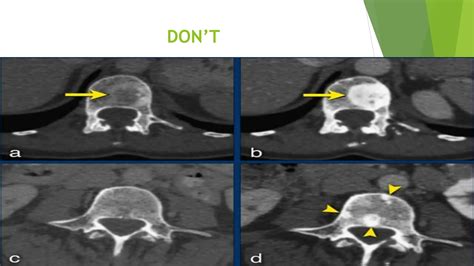 Recist Criteria Response Evaluation Criteria In Solid Tumorspptx