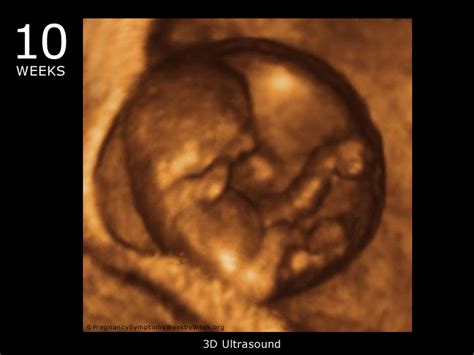 10 Weeks Pregnant ─ Pregnancy Symptoms Pregnancy Symptoms Week By Week
