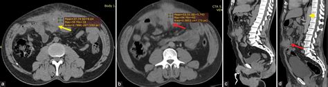 Paradox Of Aggressive Benignity In Abdominal Wall Case Reports In