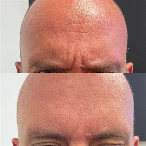 Botox 1 Restoration Wellness And Medspa