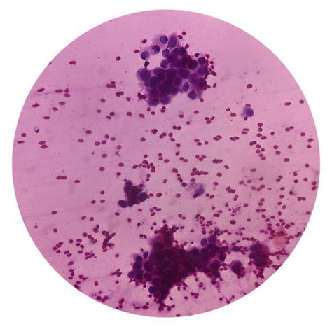 170개 이상의 액와림프절 스톡 사진 그림 및 Royalty Free 이미지 Istock