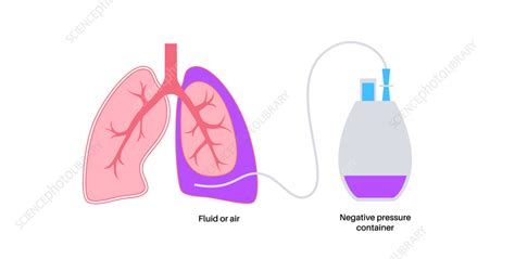 Tunnelled Pleural Catheter Illustration Stock Image F041 5942