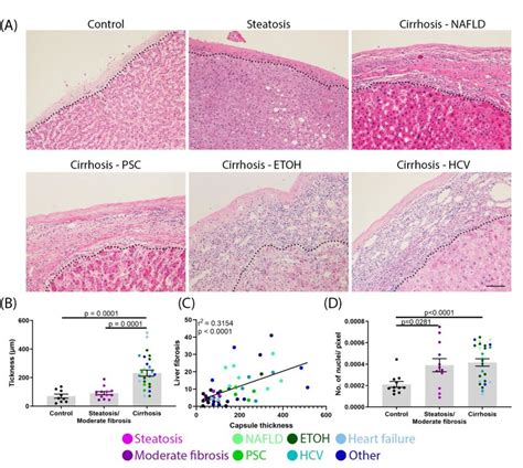 Liver Capsule At Stanley Urbina Blog