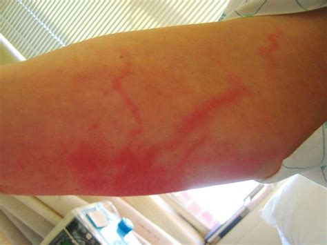 MRSA MRSA Causes Symptoms Treatments