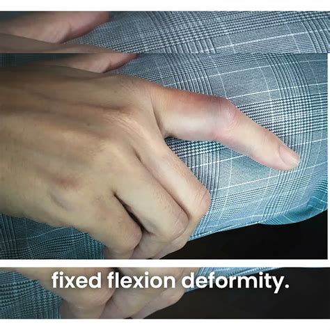 Buddy Taping A Pip Joint Injury Can Cause A Fixed Flexion Deformity