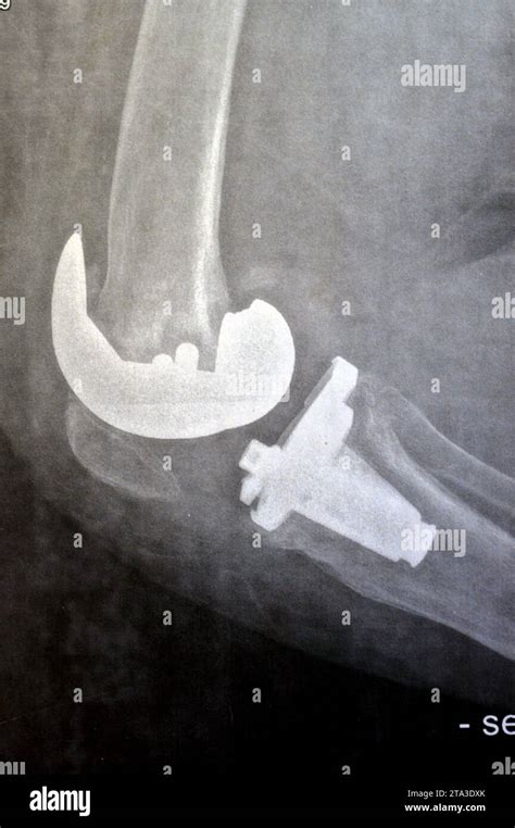 Plain X Ray Showing Total Right Knee Replacement Arthroplasty After Joint Osteoarthritis Grade 4