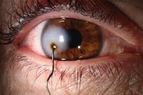 Trauma Ocular Ofthalmos