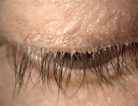 Demodex Blepharitis