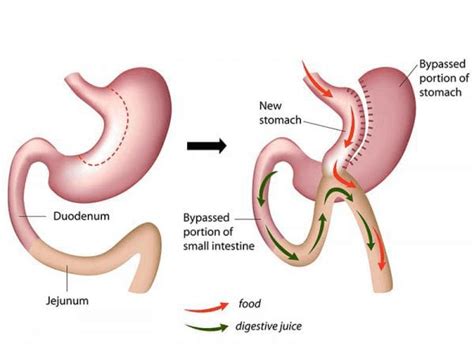 Gastric Bypass Techniques Dr Stephen Watson